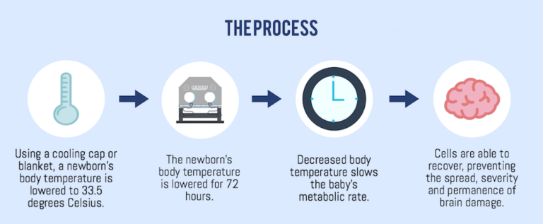 Therapeutic Hypothermia (Cooling Therapy) for Babies with Hypoxic ...