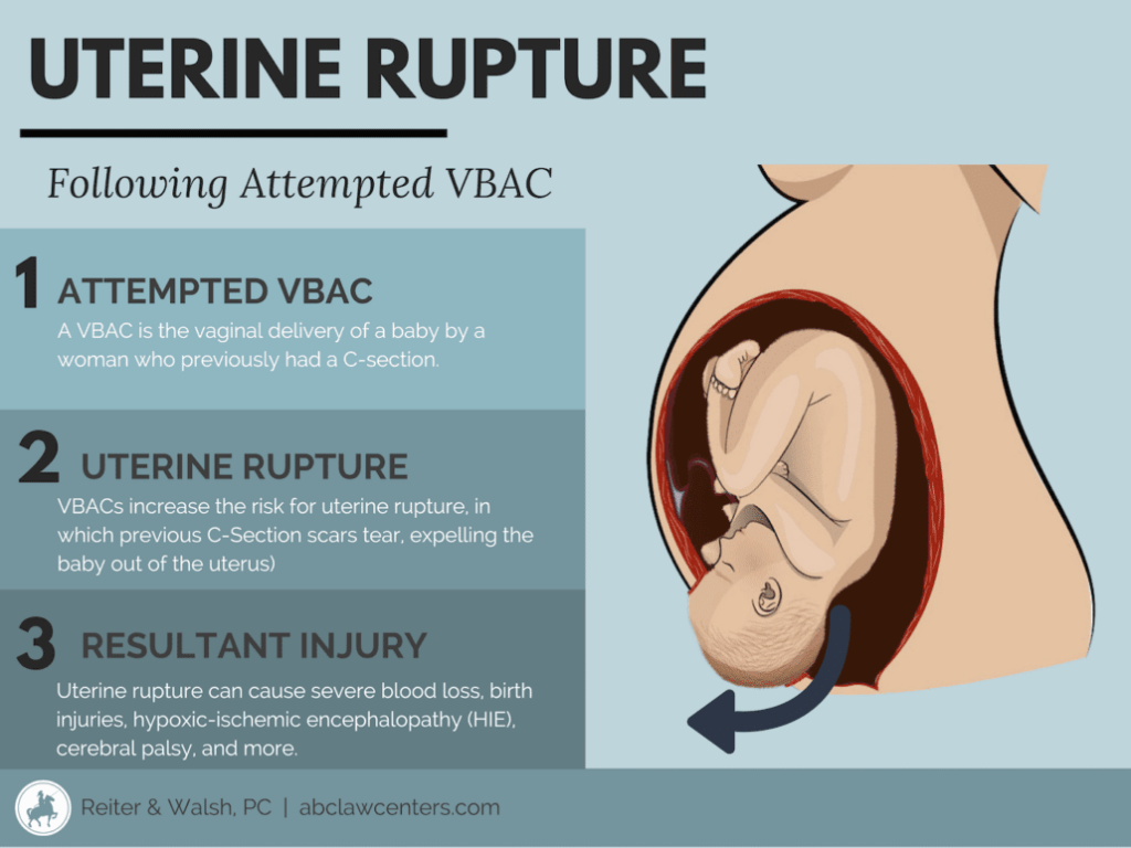 VBAC (Vaginal Birth After C-Section) Delivery | ABC Law Centers: Birth ...
